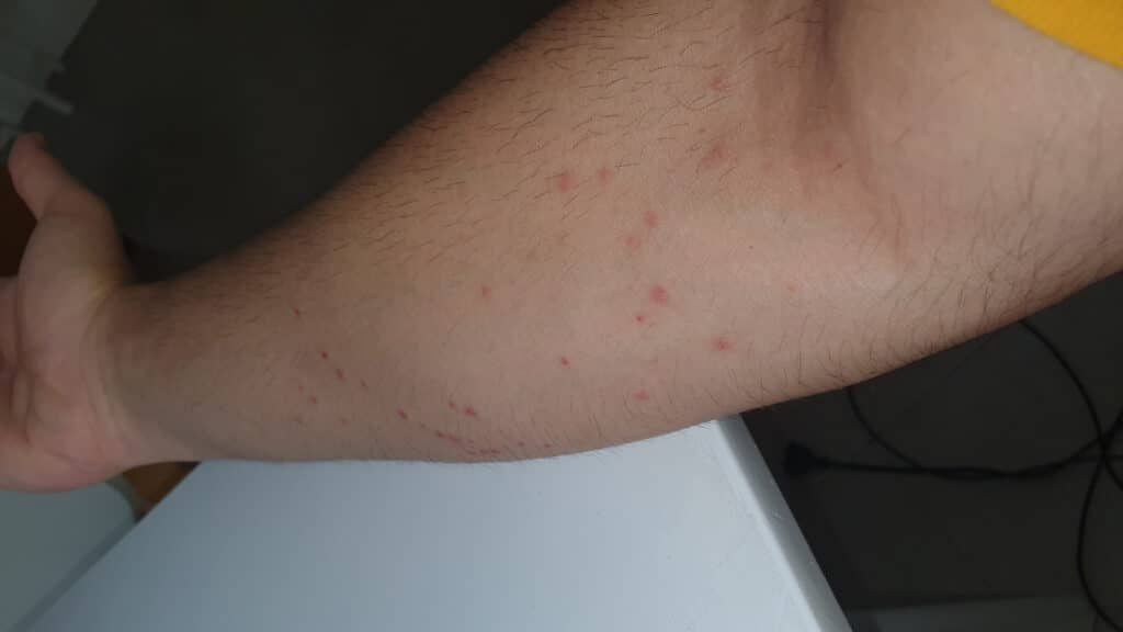 Bed Bite Marks: 5 Causes And How To Fix Them Quickly