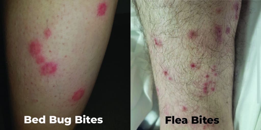 Bed Bug Bites Vs Flea Bites: 5 Key Differences Explained Bed Bug Bites Vs Flea Bites: 5 Key Differences Explained