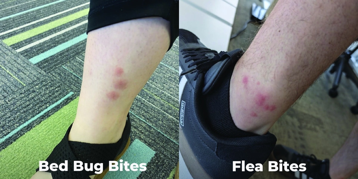 Bed Bug Bites Vs Flea Bites: 5 Key Differences Explained Bed Bug Bites Vs Flea Bites: 5 Key Differences Explained