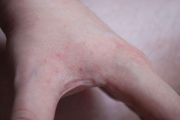 Bed Bug Rash: The Essential Guide includes Pictures and Signs.
